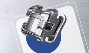 ¿Por qué los brackets Damon son la opción preferida por los pacientes ...