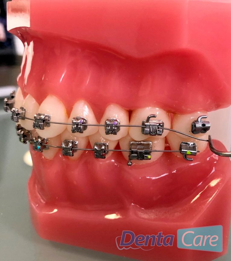 Brackets Archivos - Denta Care