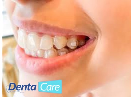 Invisalign Attachments en México - Denta Care