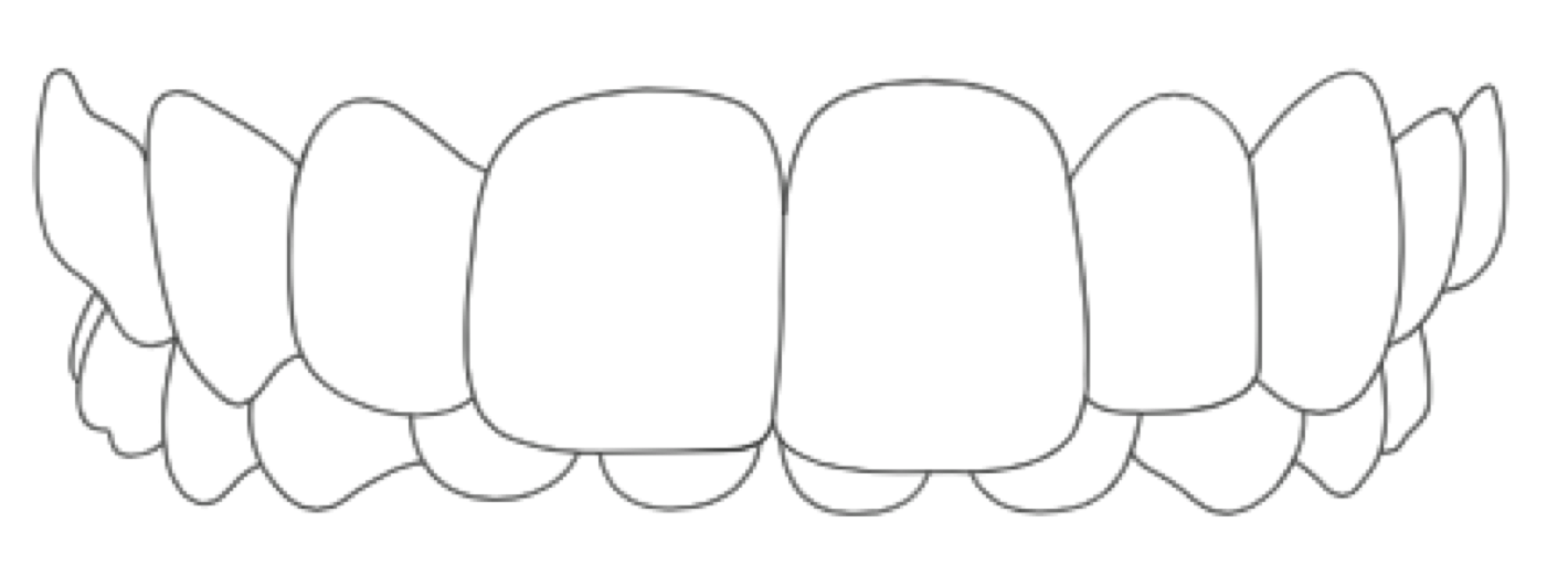 ¿Sabes que es la mordida profunda? - Denta Care
