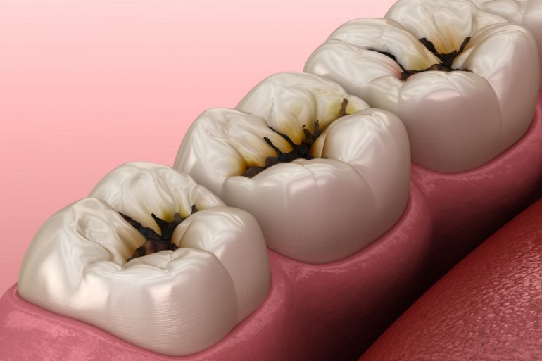La Verdad de las Caries Dentales - Denta Care