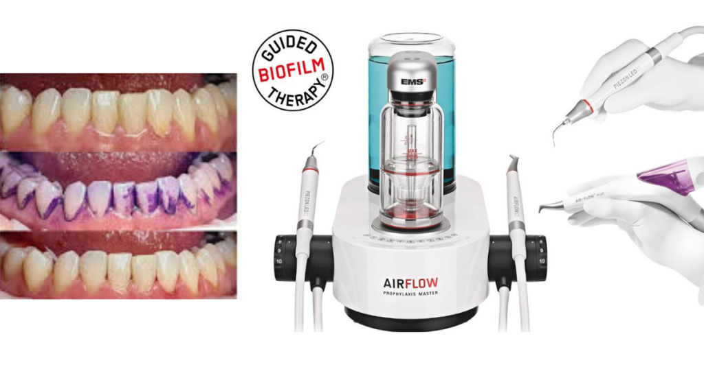 Descubre una Limpieza Dental Única con GBT & Airflow Handy 3.0 - Denta Care