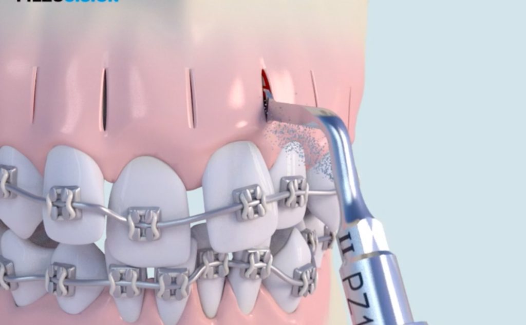 La Ortodoncia Acelerada, Ortodoncia más Rápida y Efectiva - Denta Care