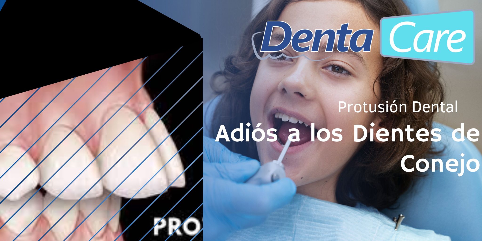 ¿Sabes Qué es la Protrusión Dental? - Denta Care