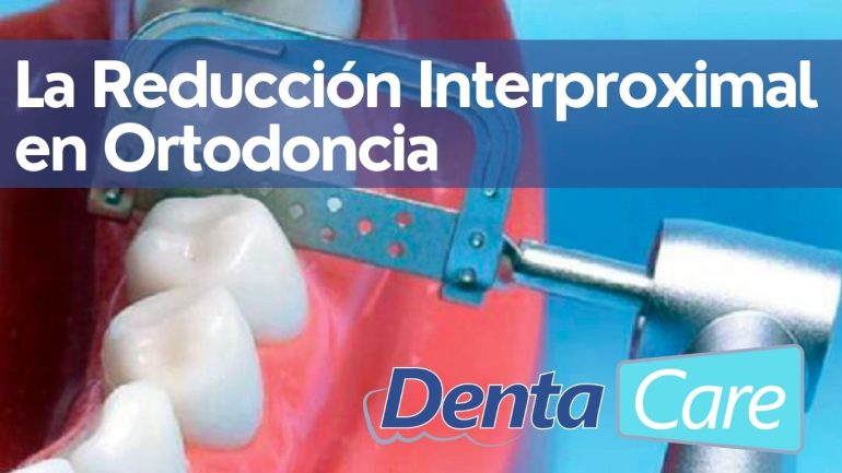 Conoce La Reducción Interproximal o Stripping - Una Técnica usada en ...