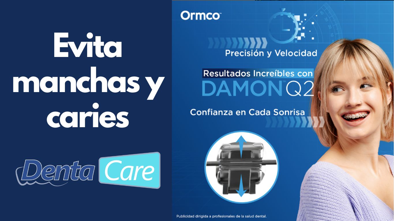 Cómo cuidar tus dientes con brackets para evitar manchas o caries ...